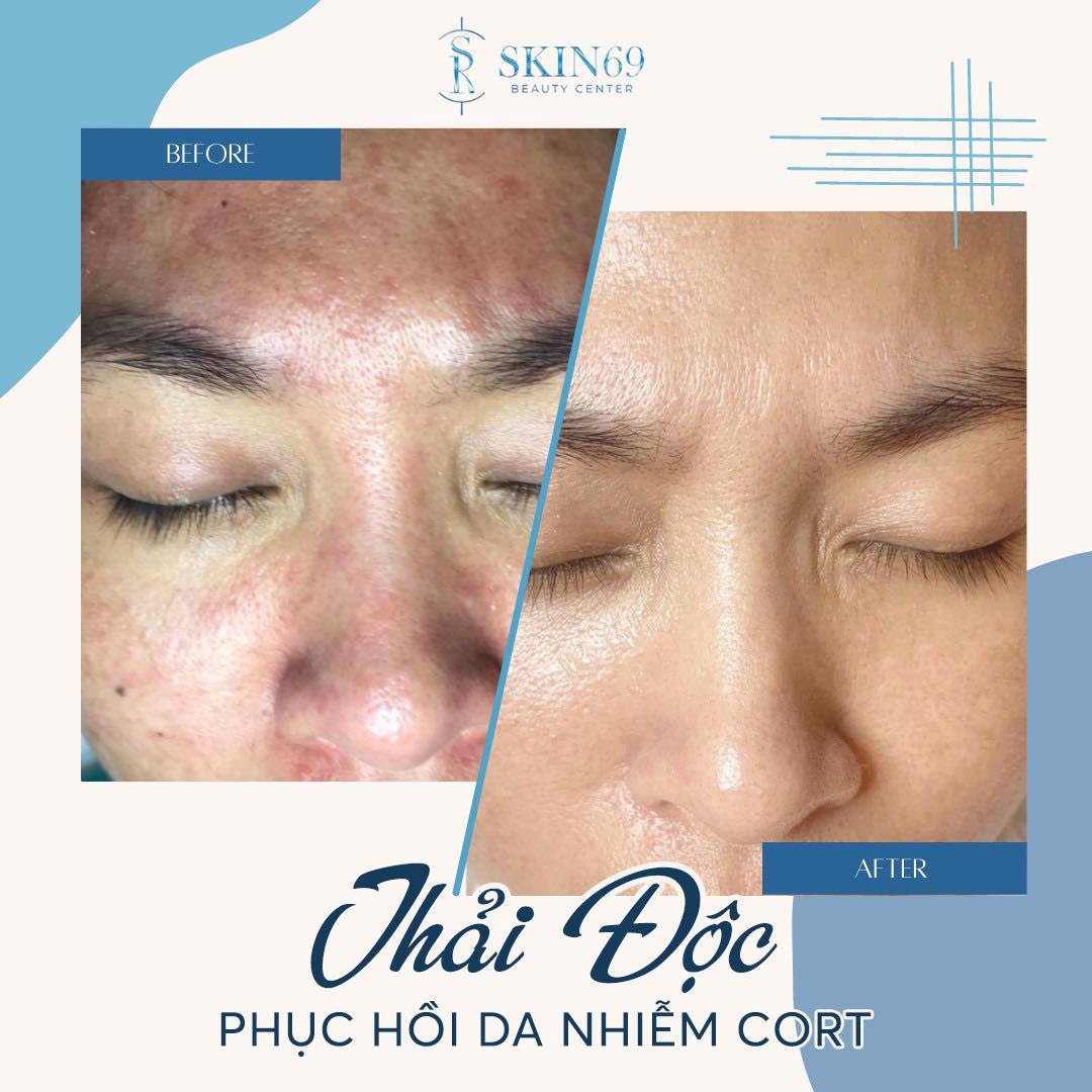 Nguyên nhân da nhiễm corticoid | Chi phí điều trị da nhiễm corticoid ...